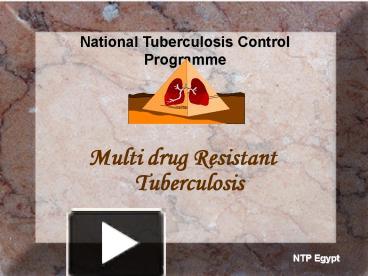 Multi drug Resistant Tuberculosis presentation | free to view