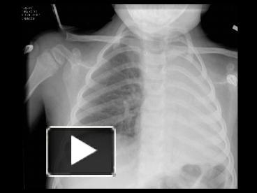 Airway Foreign Body presentation | free to view