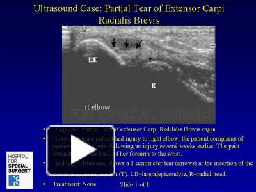 PPT – Ultrasound Case: Partial Tear of Extensor Carpi Radialis Brevis ...