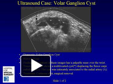 Ultrasound Case: Volar Ganglion Cyst presentation | free to view