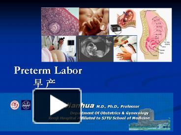 PPT – Preterm Labor PowerPoint presentation | free to view - id: 1b43cd ...