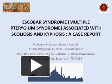 PPT – ESCOBAR SYNDROME MULTIPLE PTERYGIUM SYNDROME ASSOCIATED WITH ...