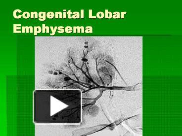 Congenital Lobar Emphysema presentation | free to view
