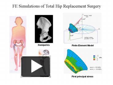 Hemipelvis presentation | free to download