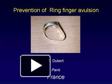 PPT – Prevention of Ring finger avulsion PowerPoint presentation | free ...
