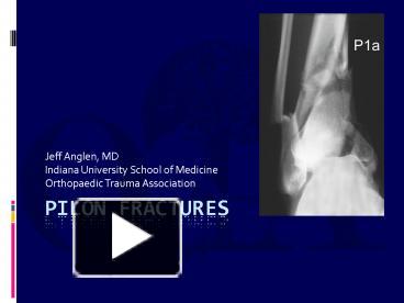PIlon Fractures presentation | free to view
