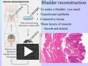 Bladder reconstruction presentation | free to view