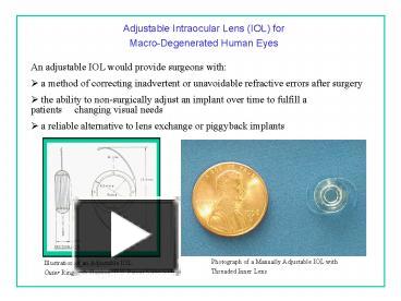 Adjustable Intraocular Lens IOL for presentation | free to view