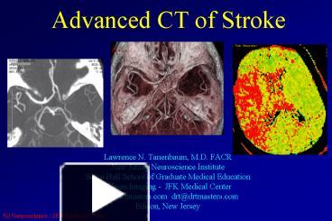 PPT – Advanced CT of Stroke PowerPoint presentation | free to view - id ...