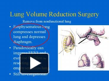 Lung Volume Reduction Surgery presentation | free to view
