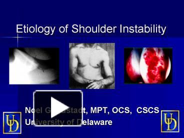 Etiology of Shoulder Instability presentation | free to view