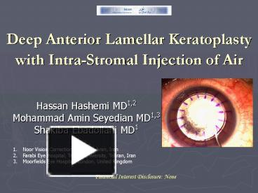 PPT – Deep Anterior Lamellar Keratoplasty with IntraStromal Injection ...