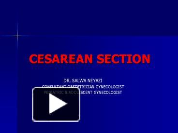 CESAREAN SECTION presentation | free to view