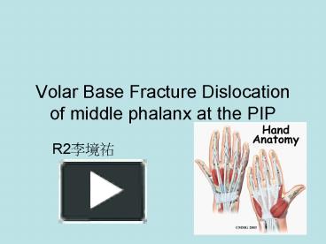 PPT – Volar Base Fracture Dislocation of middle phalanx at the PIP ...