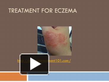 PPT – Treatment For Eczema PowerPoint presentation | free to view - id ...