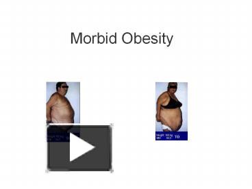 Morbid Obesity Morbid Obesity- What is it? The term morbid presentation ...