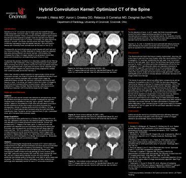 PPT – Hybrid Convolution Kernel: Optimized CT of the Spine PowerPoint ...