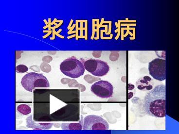 Monoclonal Gammopathy of Undetermined Significance (MGUS) presentation ...