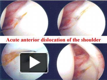 Acute anterior dislocation of the shoulder presentation | free to download