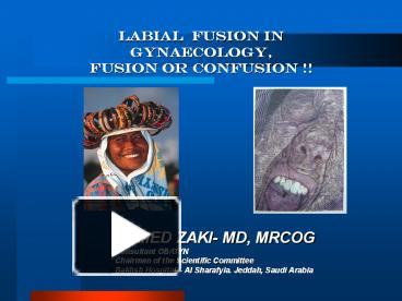 Labial fusion in gynaecology, Fusion oR confusion !! AHMED presentation ...