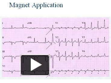 Pacemakers and Internal Cardiac Defibrillators presentation | free to view