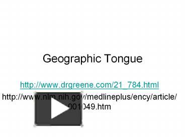 Geographic Tongue presentation | free to view