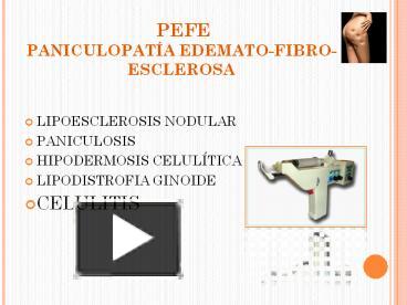 PPT – PEFE PANICULOPATНA EDEMATO-FIBRO-ESCLEROSA PowerPoint ...