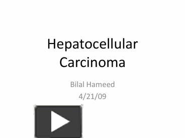 Hepatocellular Carcinoma presentation | free to view