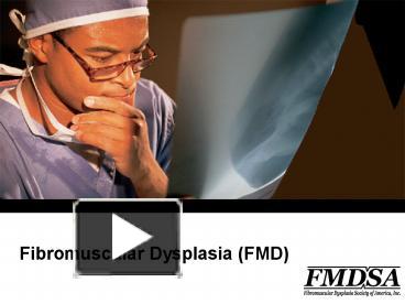 Fibromuscular Dysplasia FMD presentation | free to view