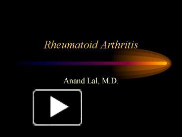 PPT – Rheumatoid Arthritis PowerPoint presentation | free to view - id ...