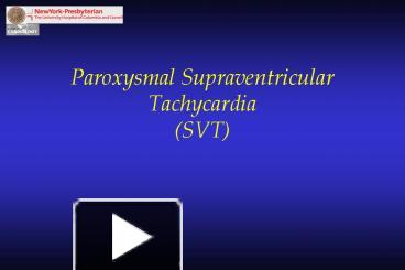 Paroxysmal Supraventricular Tachycardia (SVT) presentation | free to view