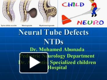 Neural Tube Defects NTDs presentation | free to view