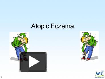PPT – Atopic Eczema PowerPoint presentation | free to view - id: 3e87fb ...