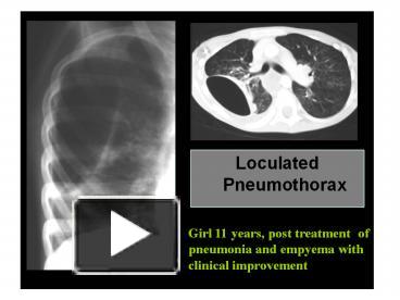 Loculated Pneumothorax presentation | free to download