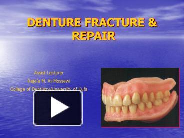 DENTURE FRACTURE presentation | free to download