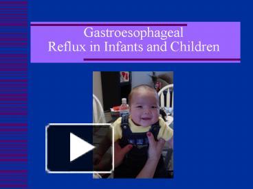 Gastroesophageal Reflux in Infants and Children presentation | free to ...