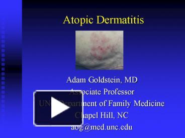 PPT – Atopic Dermatitis PowerPoint presentation | free to view - id ...