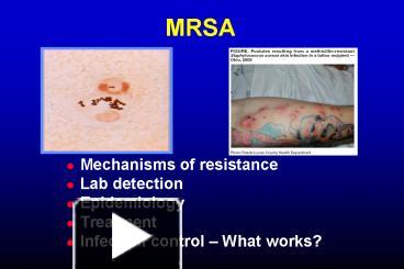 MRSA presentation | free to view