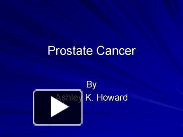 Prostate Cancer presentation | free to view
