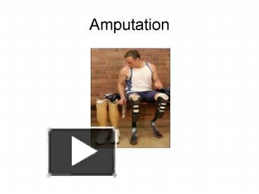 Amputation presentation | free to download