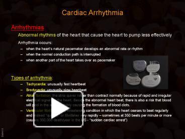 Cardiac Arrhythmia presentation | free to view