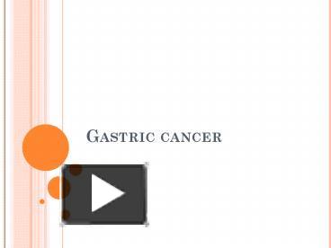 Gastric cancer presentation | free to view