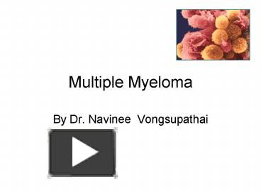 Multiple Myeloma presentation | free to view