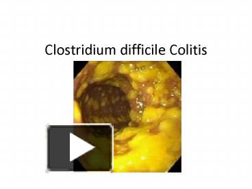 Clostridium difficile Colitis presentation | free to view