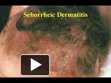 Seborrheic Dermatitis presentation | free to view