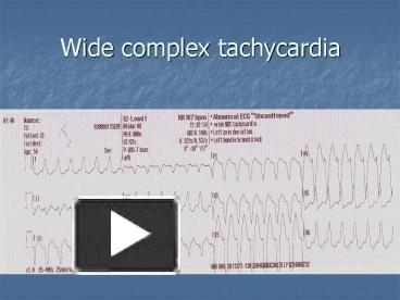 Wide complex tachycardia presentation | free to view