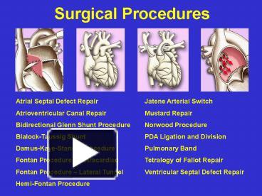 PPT – Surgical Procedures PowerPoint presentation | free to view - id ...