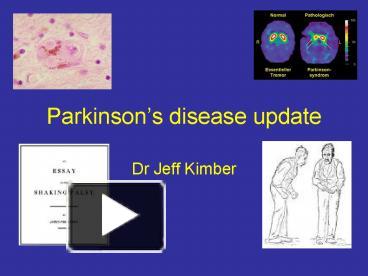 PPT – Parkinson PowerPoint presentation | free to download - id: 486886 ...