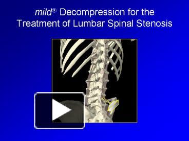 mild? Decompression for the Treatment of Lumbar Spinal Stenosis ...
