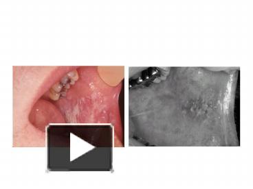 Cheek chewing presentation | free to view